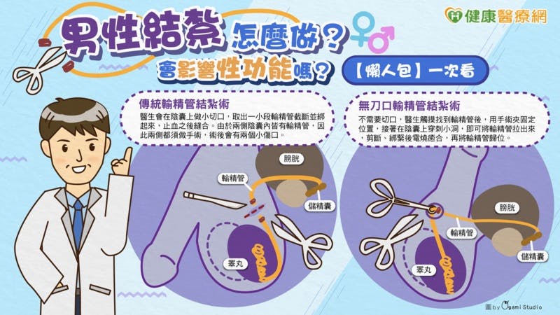 男性結紮手術QA：會影響男性雄風嗎？術後反悔是否能再恢復生育？ - TNL The News Lens 關鍵評論網